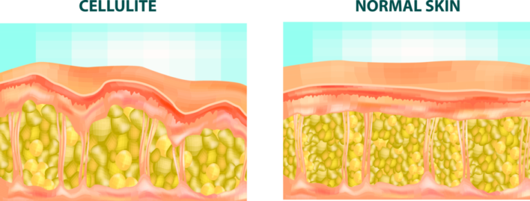 Cellulite Treatment in Albury-Wodonga