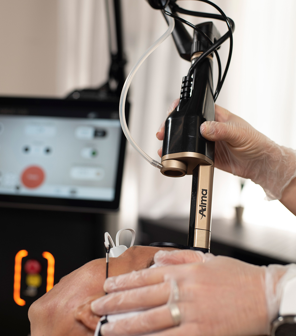 Alma Hybrid Laser Treatment | Dr Queenie Chan