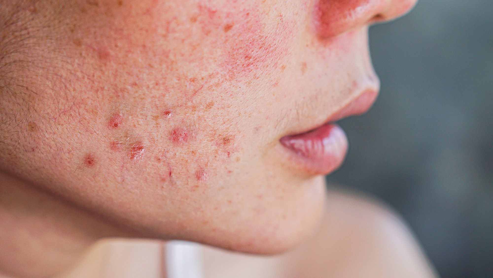 3 Common Types of Acne: How to Spot the Differences