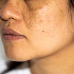 What is Hyperpigmentation? Causes, Types and Treatments