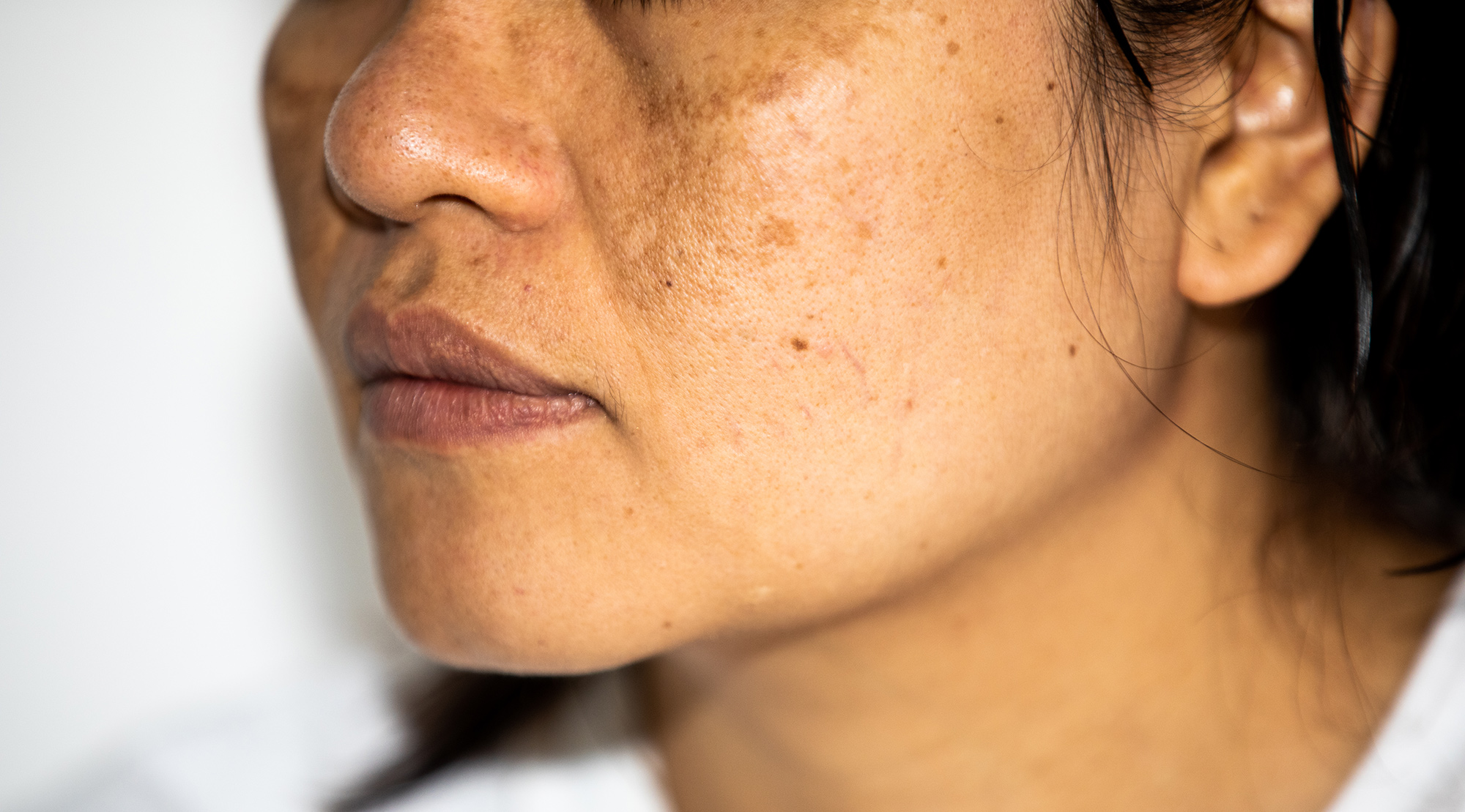 What is Hyperpigmentation? Causes, Types and Treatments